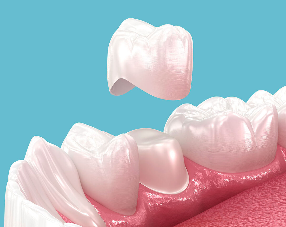 Couronne dentaire céramique Paris 15 - Dentiste Paris 15, Balard